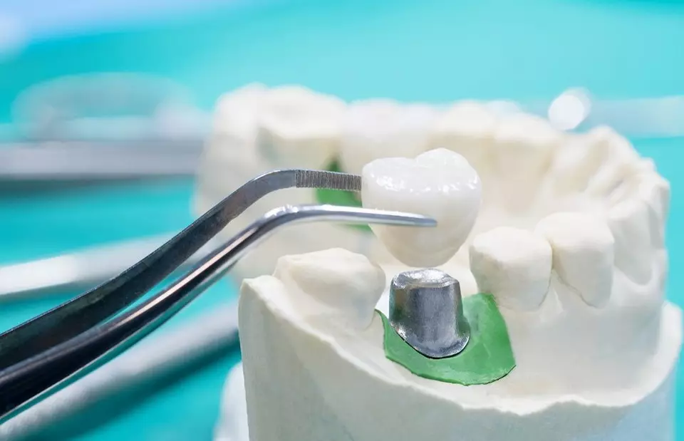 Coroa ou selo: O que exatamente protege os dentes e o que - um desperdício excessivo de dinheiro