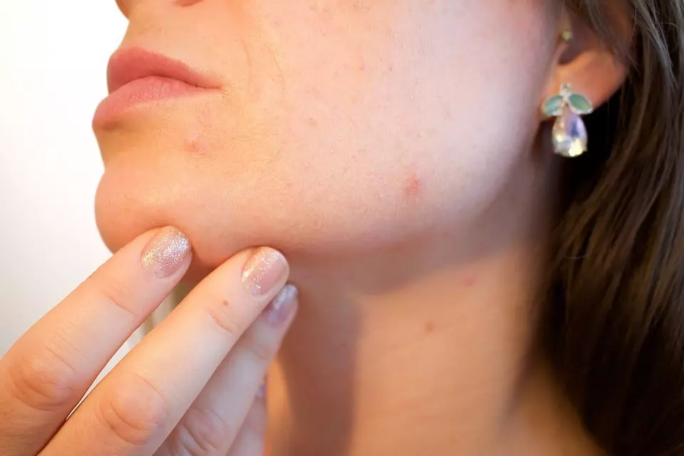 Como se livrar da acne no rosto por noite ou para sempre? Guia completo